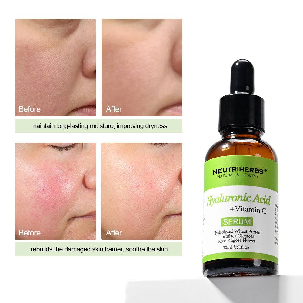 Hyaluronic acid oily skin store